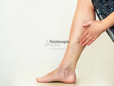 Tromboflebitis | Qué es, qué estructuras afecta, síntomas, signos ...