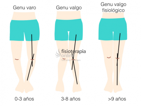 Valgo de rodilla | Qué es, causas, síntomas, a quién afecta y tratamiento