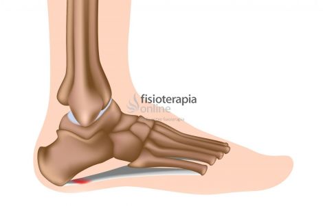 Qué Es La Fascitis Plantar Causas Diagnóstico Y Tratamiento