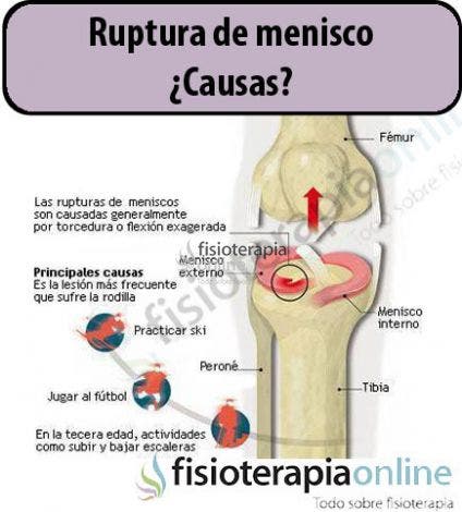 Conoce lo que supone una rotura de menisco, sus causas, consecuencias y ...