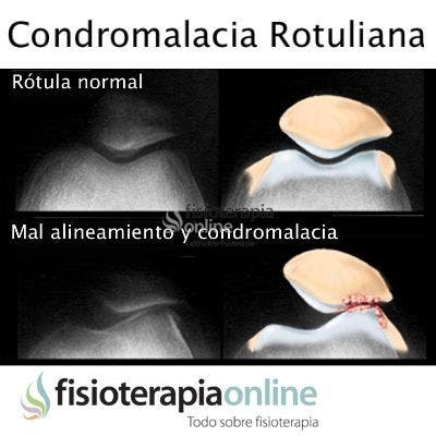 Condromalacia o condropatía rotuliana, causas, y tratamiento de una ...