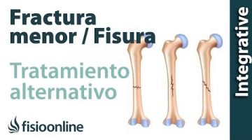 Tendinitis o tendinosis del Psoas iliaco. Psoitis. ¿Qué es? | FisioOnline