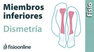 Hipertrofia de las articulaciones interapofisarias o facetarias. ¿Qué ...