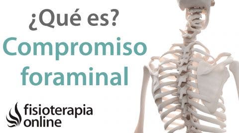 Compromiso foraminal o del neuroforamen. ¿Qué es? | Fisioterapia Online