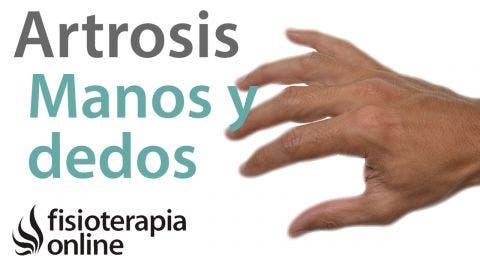 Artrosis de las manos y dedos. Síntomas, Causas, Prevención y ...