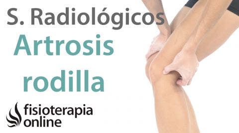 Signos radiológicos de la artrosis de rodilla | Fisioterapia Online