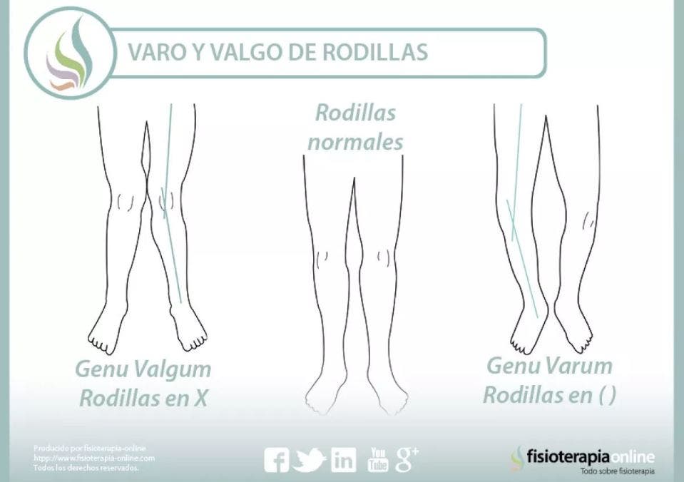 Valgo y varo de rodilla - Qué es, causas, síntomas, tratamiento y ...